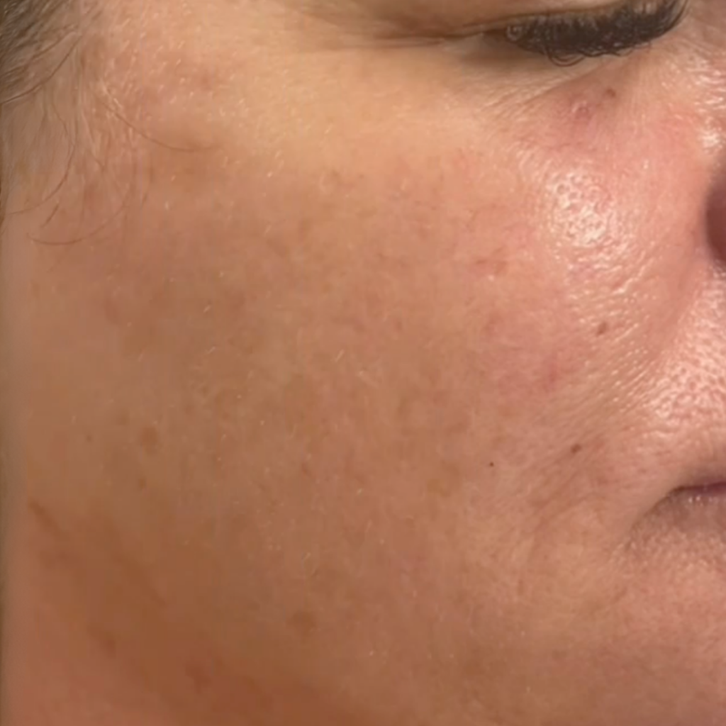 BBL Hero by Sciton Grand Rapids, MI | Grand Pearl Spa