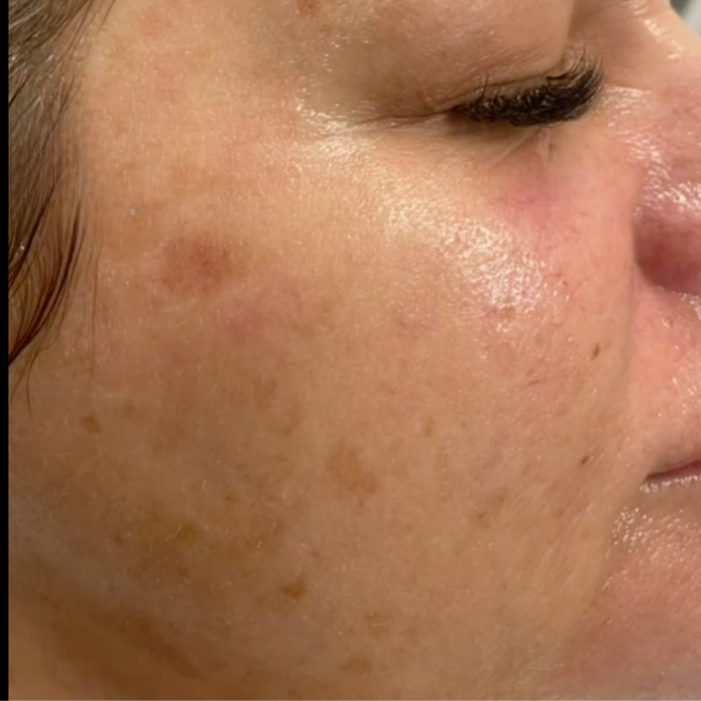 BBL Hero by Sciton Grand Rapids, MI | Grand Pearl Spa